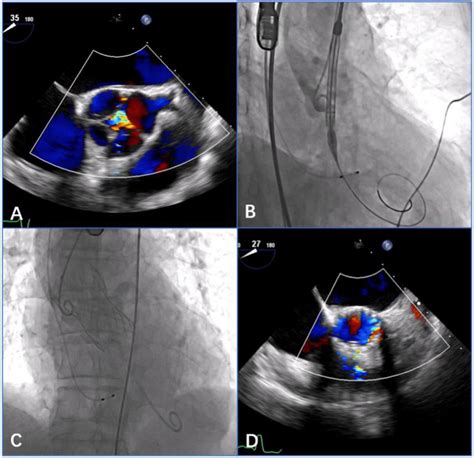 Procedural Details Of Transcatheter Aortic Valve Replacement Tavr