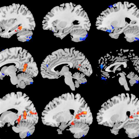 Pdf Gender Differences In Regional Brain Activity In Patients With