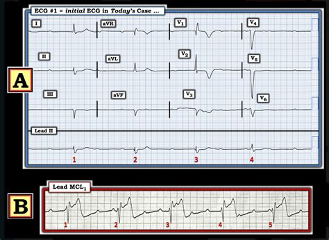 Ecg Interpretation Heres Ecg 1 From Dr Smiths Most Recent Blog