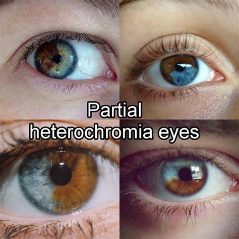 Partial Heterochromia Eyes Nel Colore Degli Occhi Occhi