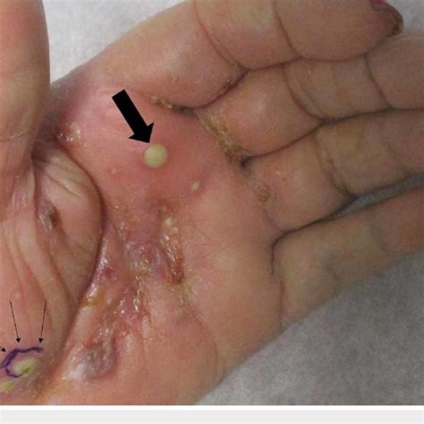 Microscopic Examination Of The Initial Section From The Skin Lesion Download Scientific Diagram