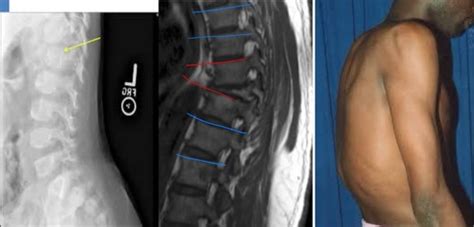 Nms Ii Thoracic Spine Insights Flashcards Quizlet