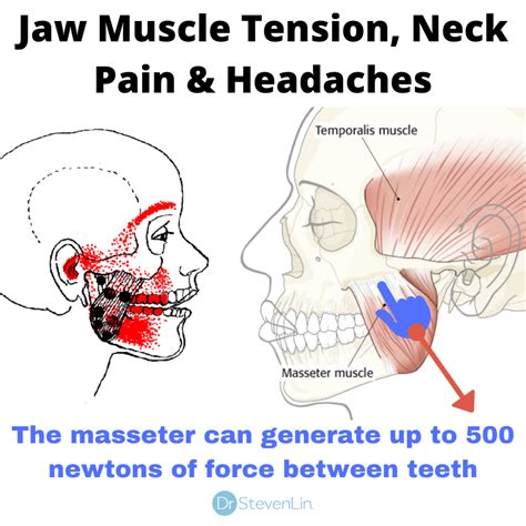 The Temporalis And Masseter Muscles Neurokinetic Therapy