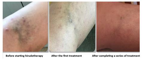 Leech Therapy For Acne