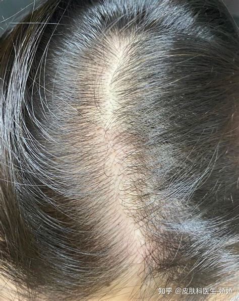 女生脱发很严重该如何解决？