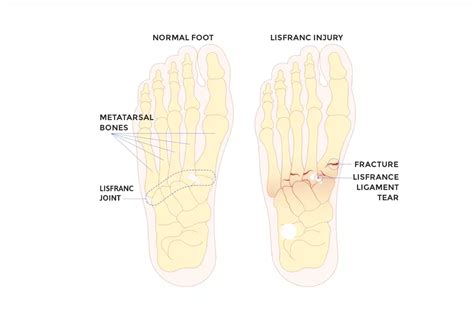 Lisfranc Injury Fracture Symptoms Treatments And Recovery Tips