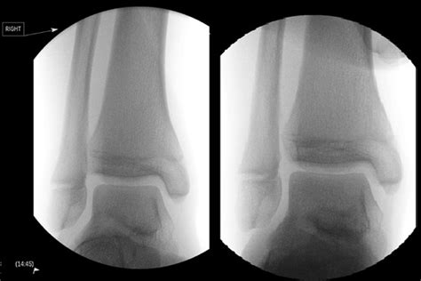 Distal Tibiofibular Joint X Ray