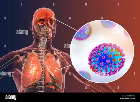 Computer Illustrations Showing The Common Complications Of Flu