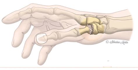 Arthrose Du Pouce Ou Rhizarthrose Alès Chirortho