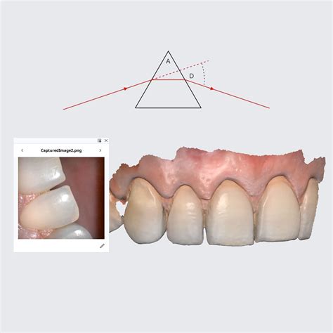Translucent Enamel Is A Motherdoctor For All Intra Oral Scanners And