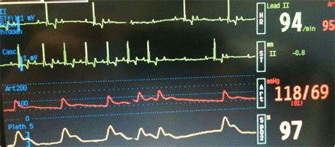 Hyperkalemia Ecg Cat
