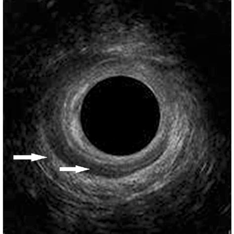 Endoanal Ultrasound Image The Hyperechoic Outer Circle Is The External Download Scientific