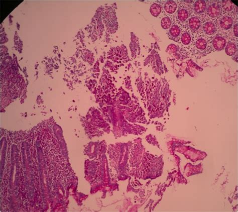 Pathology Outlines Entamoeba Histolytica