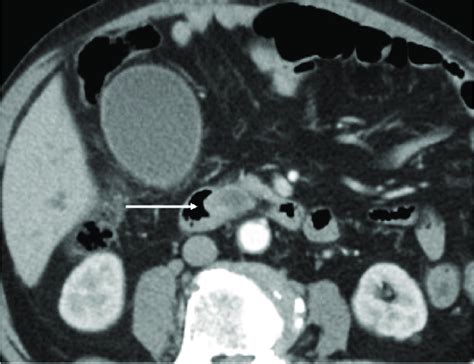 Arrow Ct Revealed A 216 Â 192 Cm Enhancing Nodule Over Ampulla Vater