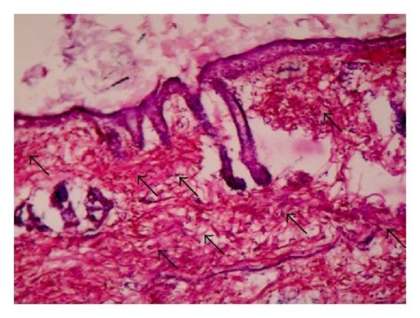 Histopathology Of Granulation Tissue At Day 10 Stained With Hande 100x