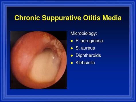 Otitis Media Icd 10