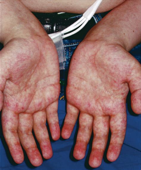 Graft Versus Host Disease The Lancet