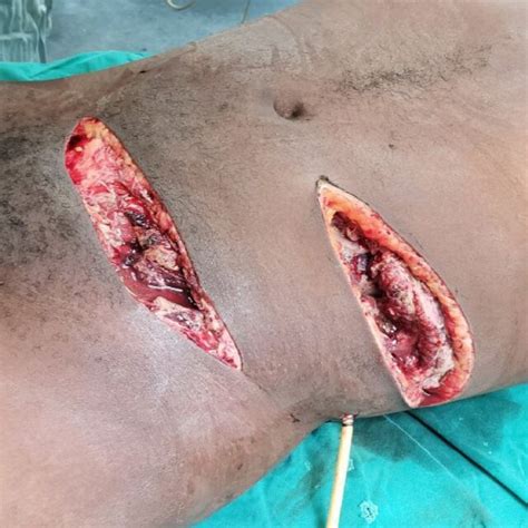 Intraoperative Finding Of The Necrotic Tissue And Foul Smelling