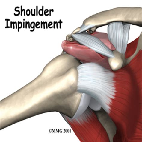Impingement Syndrome Brisbane Knee And Shoulder ClinicBrisbane Knee
