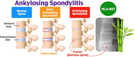 National Axial Spondyloarthritis Society Its Time To Reconnect And