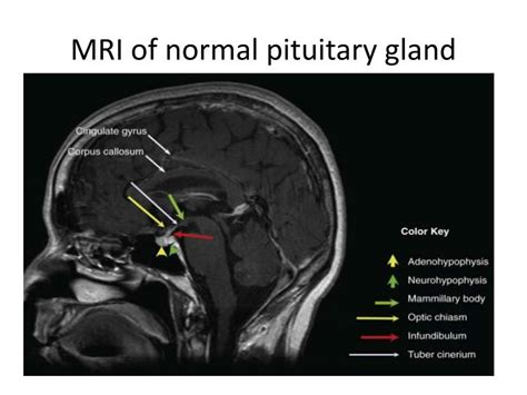Normal Pituitary Mri Scan