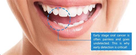 Lip Cancer Early Stages Cancerwalls