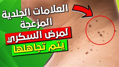 6 علامات جلدية مزعجة لمرض السكري يجب ألا تتجاهلها Youtube