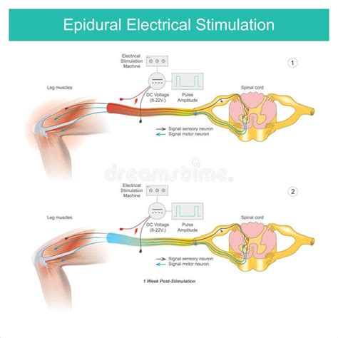Muscle Electrical Stimulation Stock Illustrations 35 Muscle Electrical Stimulation Stock