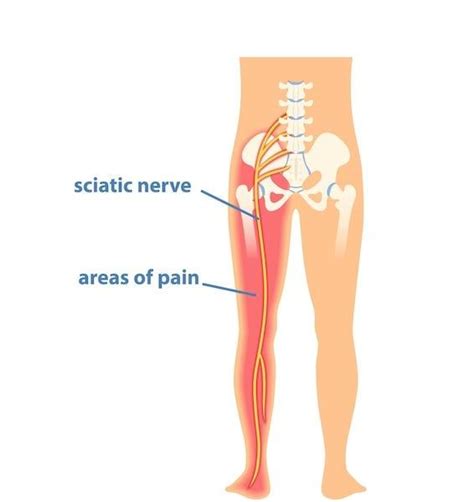 Dr Aditi Singh Phd On Linkedin Sciatica Simplified Alleviating