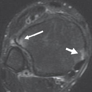 Pdf Bone Marrow Edema Patterns In The Ankle And Hindfoot