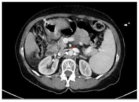 Nutcracker Radiology At Ernest Delaney Blog