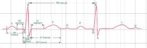 Figure From ECG Arrhythmia Classification Using Ensemble Of Features Semantic Scholar