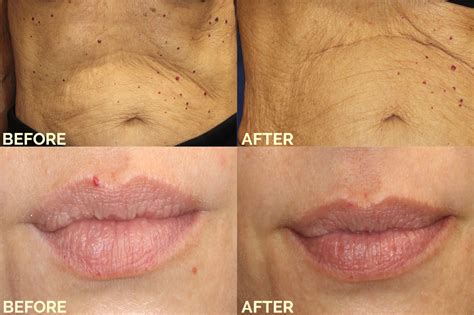 Cherry Angioma On Lip