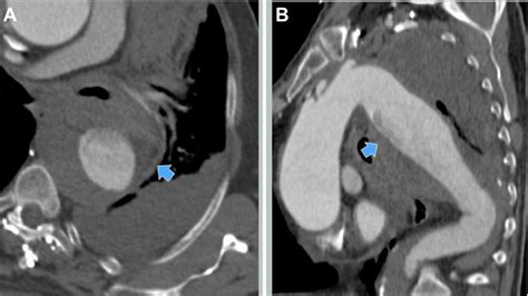 Preoperative Ct Scan A Axial View With Periaortic Hematoma Arrow