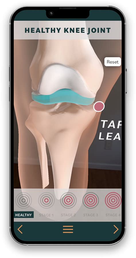 Euflexxa Dream Syndicate