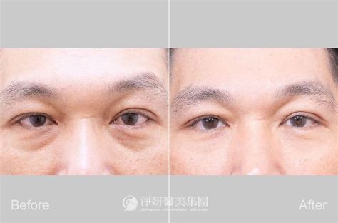 皺紋改善怎麼做？醫美會加速老化？ 除皺五大方式一次報你知
