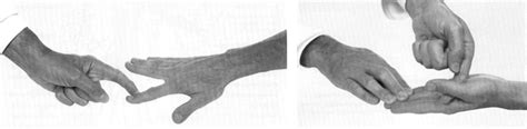 Ulnar Nerve Lesions • Litfl • Ffs