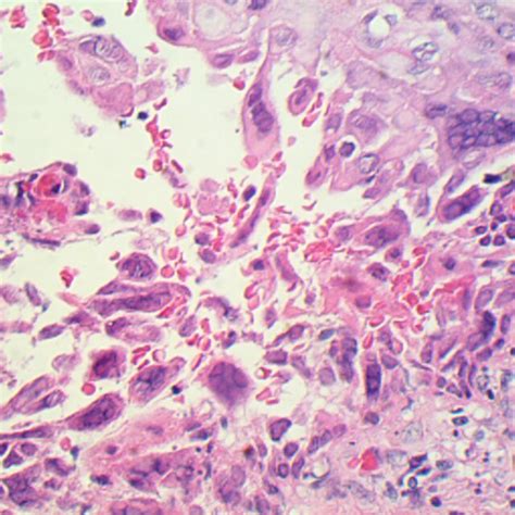 Herpes Cervicitis 40x Showing Classic Hsv Viral Cytopathic Effects Download Scientific