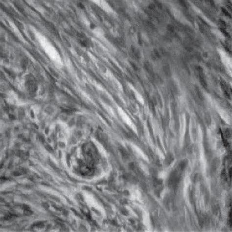 Macroscopic Appearance Of Surgical Specimen Of A Left Ovarian Thecoma