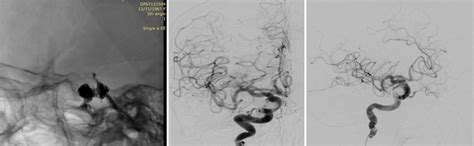 Trans Venous Approach For The Treatment Of Direct Carotid Cavernous Fistula Following Flow