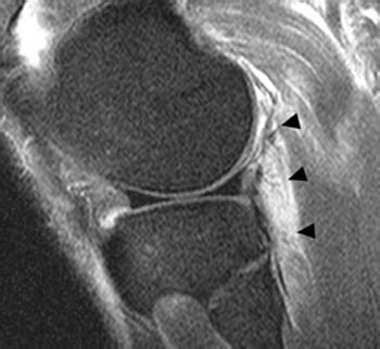 Radiology Channel Anatomy Of Bundles Of ACL And PCL