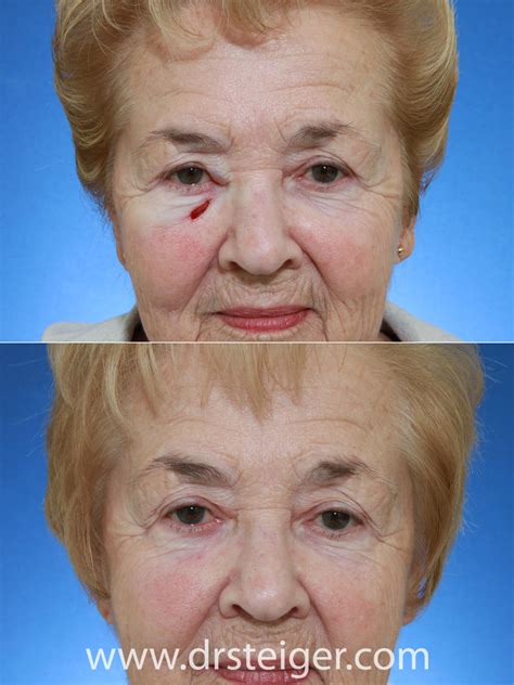 Skin Cancer Eyelid Mohs Procedure