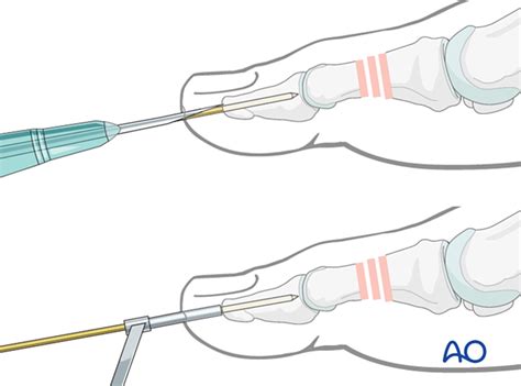 K Wire Fixation For Diaphyseal And Extraarticular End Segment Fractures Of The Proximal Hallux