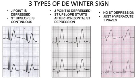 De Winter Sign Emergency Medicine Guidewire