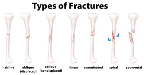 Premium Vector A Set Of Bone Fractures