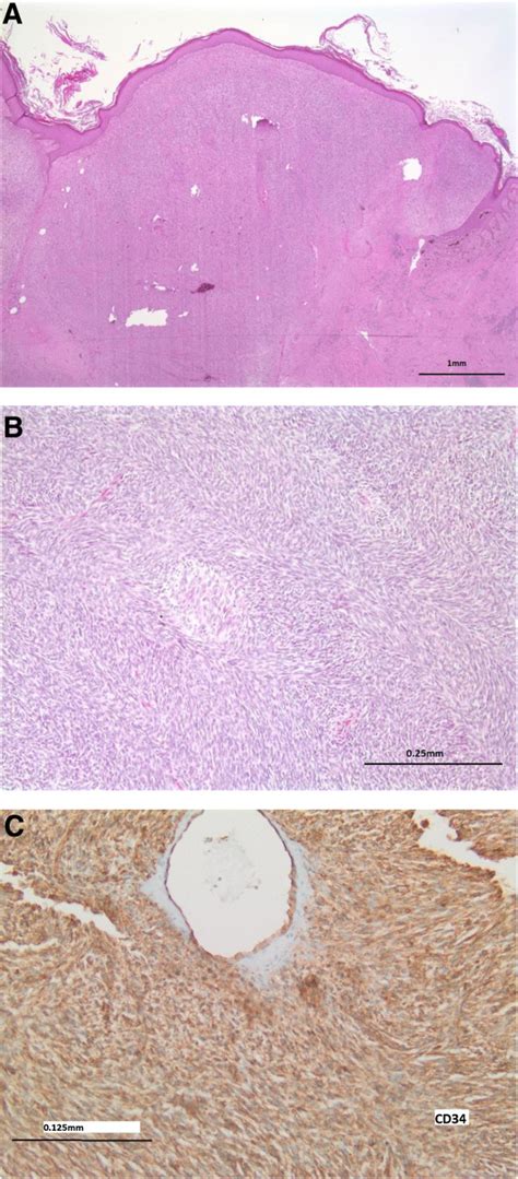 Histology Of Primary Tumor A The Left Chest Wall Mass Excised In 2005