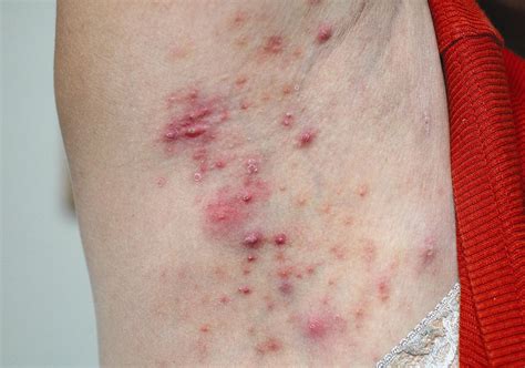 Mrsa Rash On Legs
