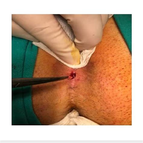 Pit Excision And Curettage Of The Sinus Download Scientific Diagram