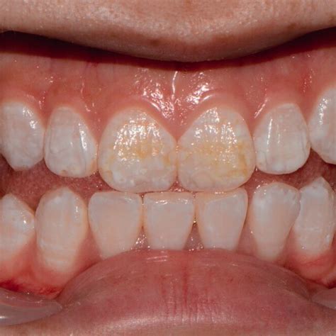 Teeth With Severe Dental Fluorosis Were Treated With Microabrasion And Download Scientific