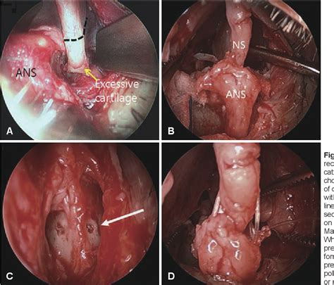Figure 2 From Correction Of Caudal Septal Dislocation Or Subluxation With Excision And Suturing